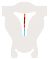 Verhütung mit der Kupferkette